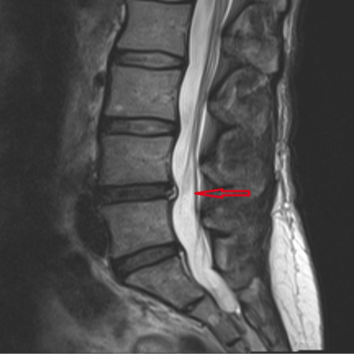 Degenerative Disc Diagnosis & Treatment NJ | Schedule Now