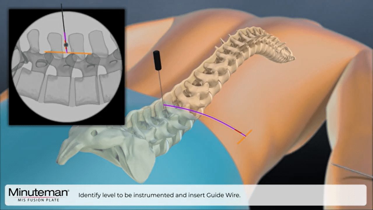 The Minuteman® Procedure | Schedule Today